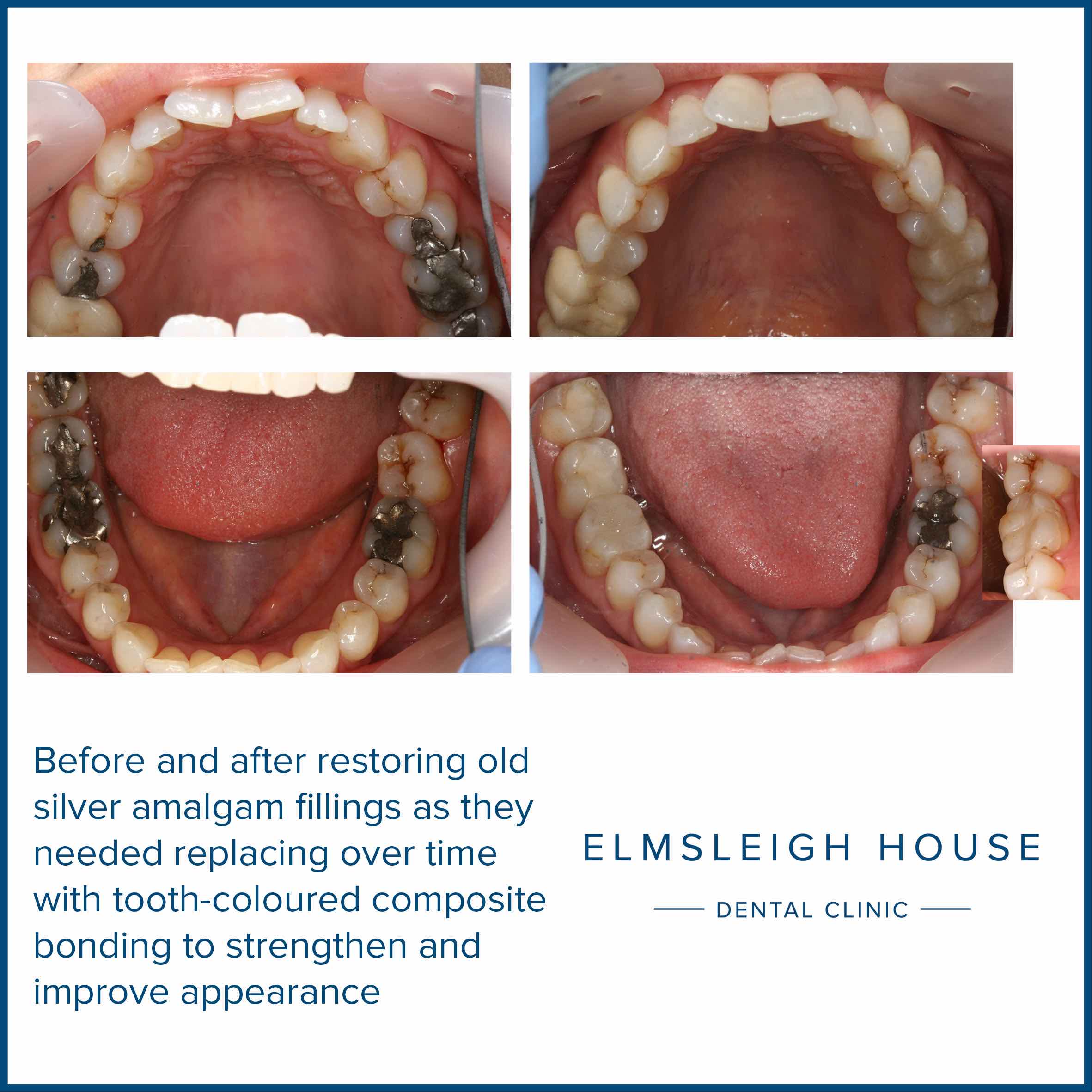 Amalgam vs composite store